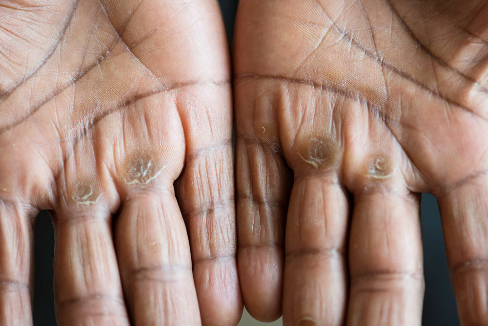 Warts and Skin Growths | HealthHub by Al-Futtaim Clinics in Dubai ...
